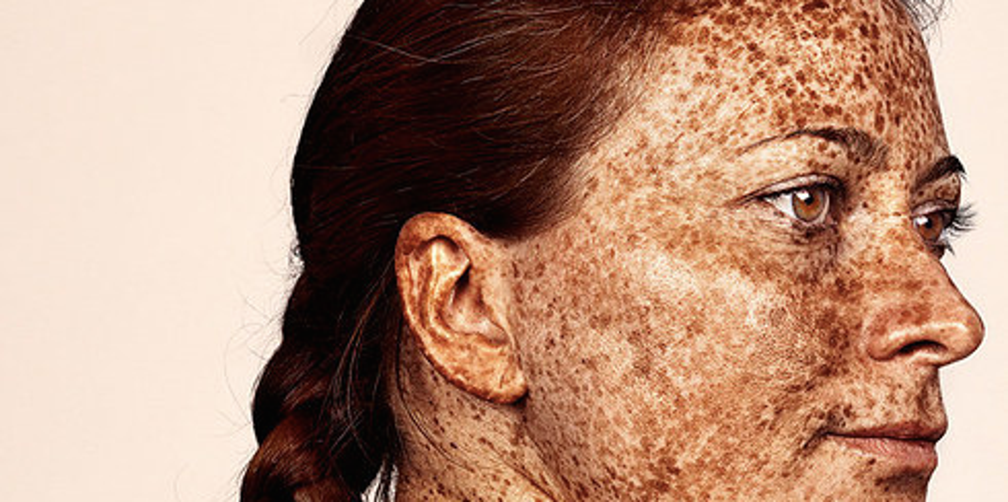 The Fabulously Freckled Get Their Close Up In Photo Project The