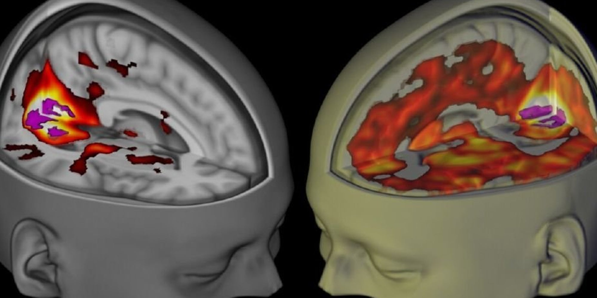 Behold, The First-Ever Brain Scans Of LSD's Mind-Altering Effects | The ...