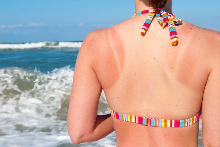 Heres Whats Actually Happening To Your Body When You Get A Sunburn Huffpost Life