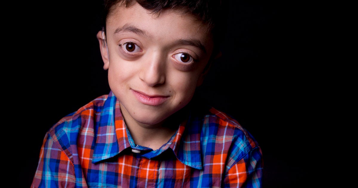 Photo Series Forces You To Look Beyond Kids' Rare Disabilities ...