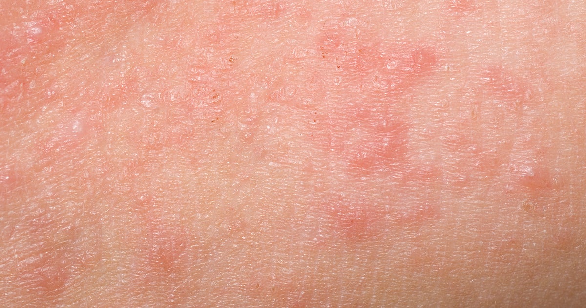 What Is Keratosis Pilaris, And Why Does It Look Like Body Acne ...