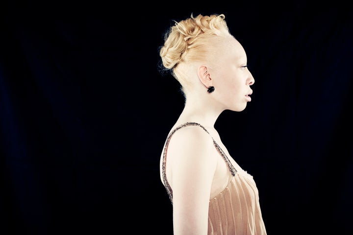 People Of Color With Albinism Ask: Where Do I Belong? | HuffPost Voices