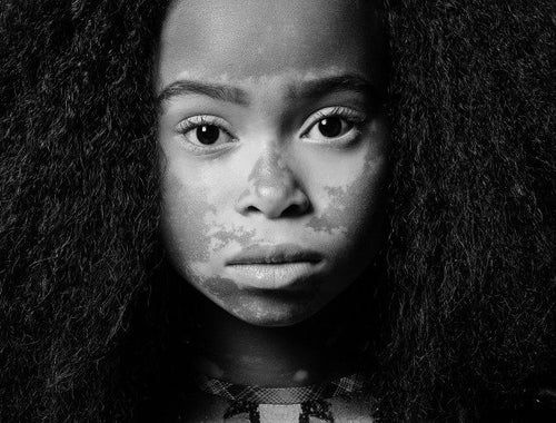 10yearold With Vitiligo Becomes An Instagram Star The Wedding That