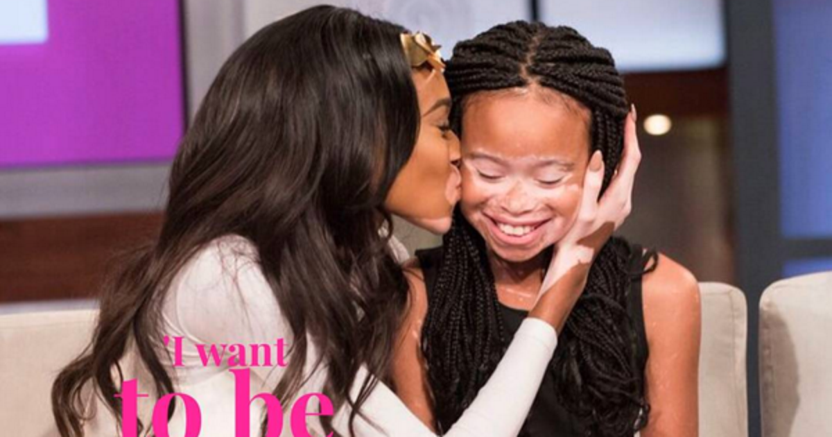 10yearold With Vitiligo Becomes An Instagram Star The Wedding That