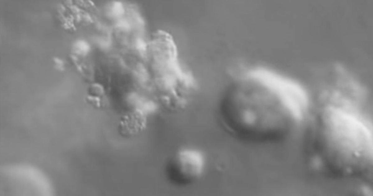 This Is What It Looks Like When Cancer Cells Form Tumors | HuffPost Impact