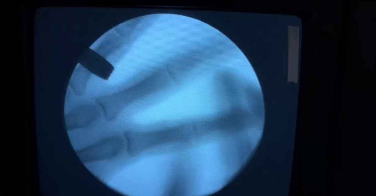 X-Ray Shows What Really Happens When You Crack Your Knuckles | HuffPost ...