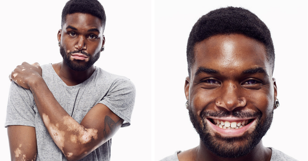 Honest Photos Show People Getting Real About Their Skin | HuffPost Life