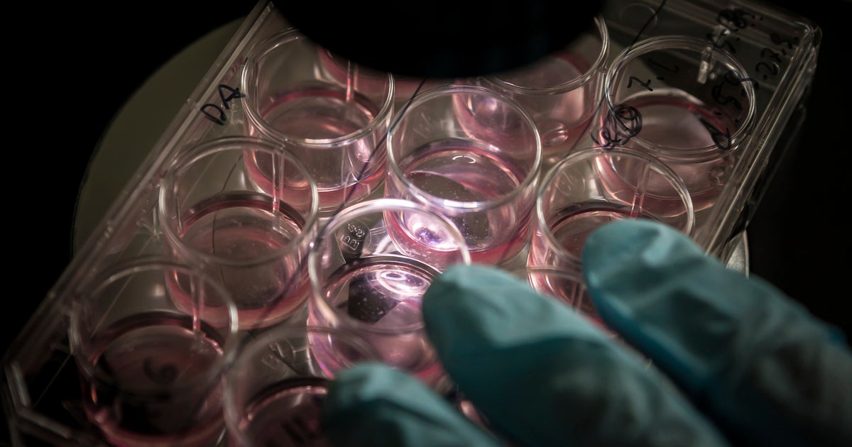 Breakthrough Stem Cell Treatment Could 'Halt' Multiple Sclerosis ...