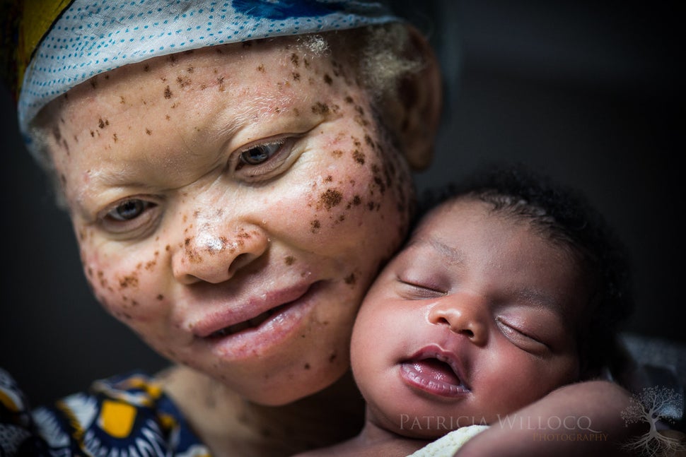 Photographer Fights The Stigma Of Albinism With Stunning Photo Essay ...