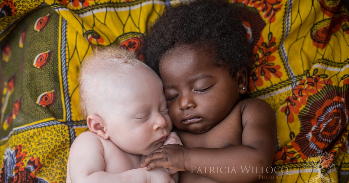 Photographer Fights The Stigma Of Albinism With Stunning Photo Essay ...