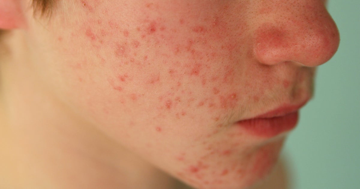 Doctors Fear 'Super Acne' As Condition Becomes Resistant To Antibiotics ...