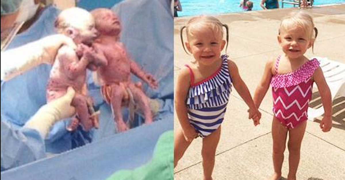 Monoamniotic Twins Born Holding Hands Are As Close As Ever, Says Mum ...