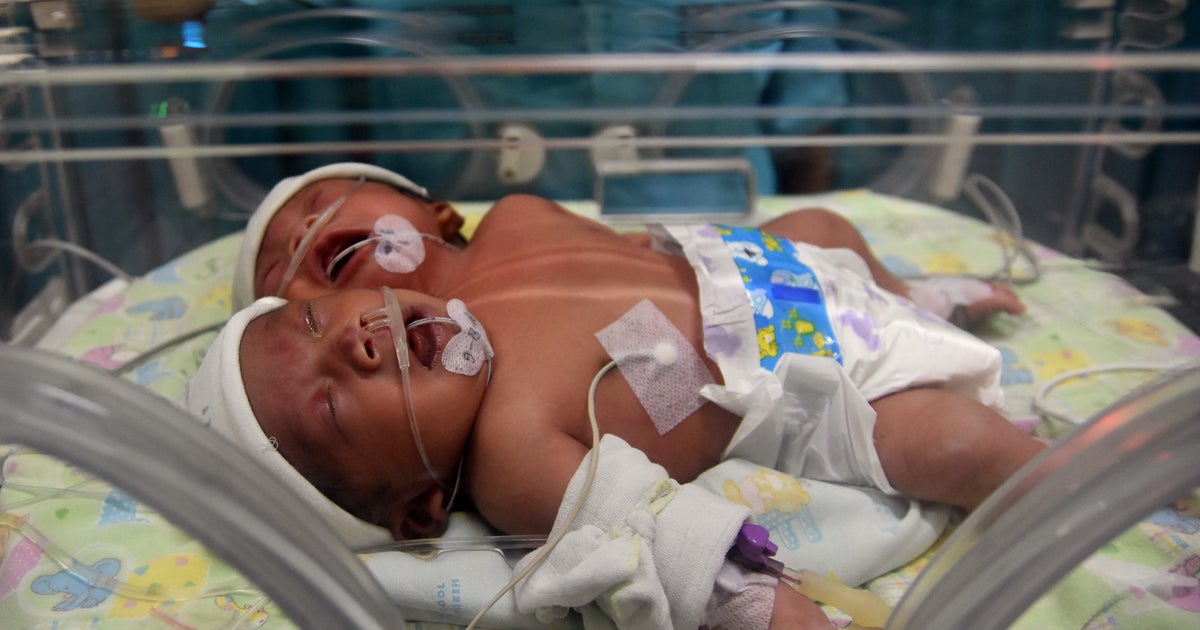 Two-Headed Baby Reportedly Born In Indonesia | HuffPost UK Parents