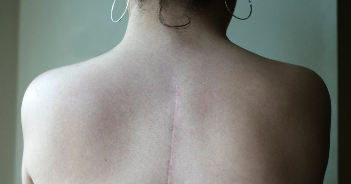 These Are The Scars Of People Who Have Narrowly Escaped Death ...