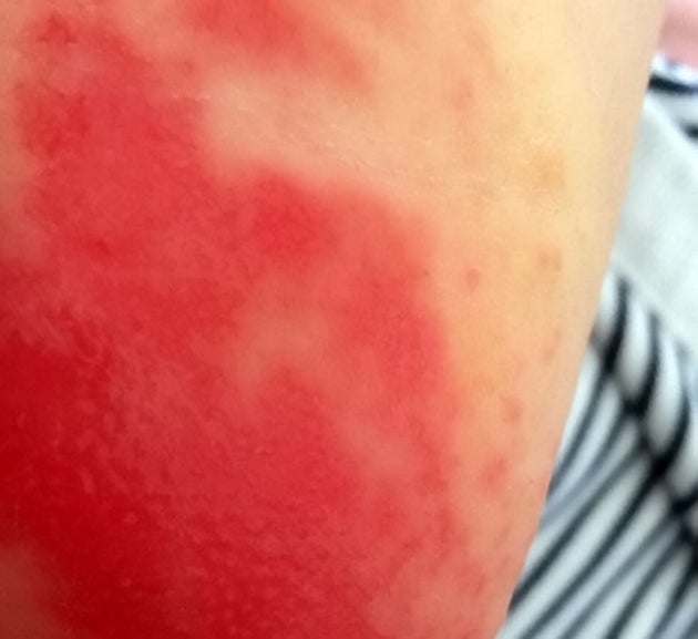 Baby Suffered Severe Chemical Burns After Wearing Morrisons' Nappies ...