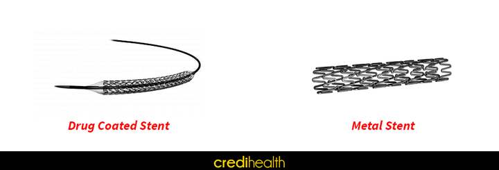 Types of Stents - How to choose? | HuffPost Contributor