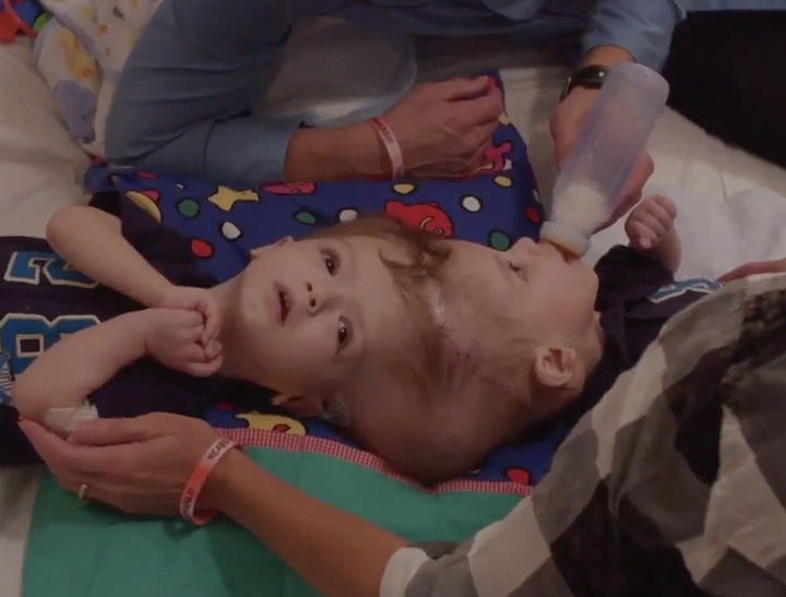 What Causes Some Twins To Be Born Conjoined? | HuffPost Life