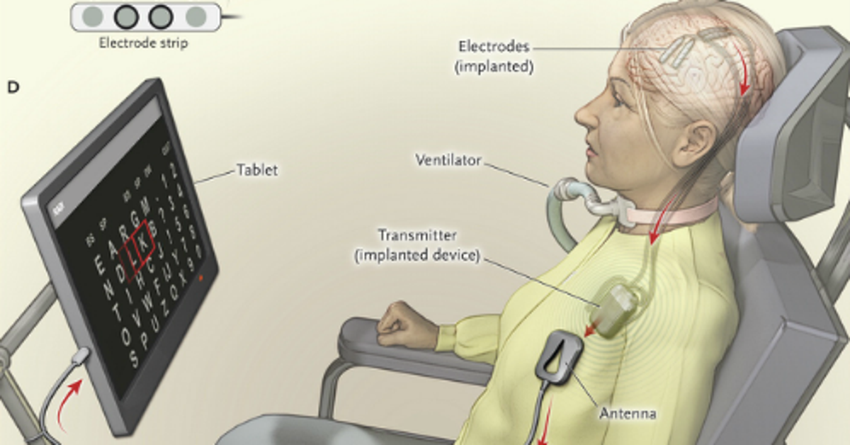 Paralysed Woman 'Locked In' Her Body Can Communicate Again After Brain ...