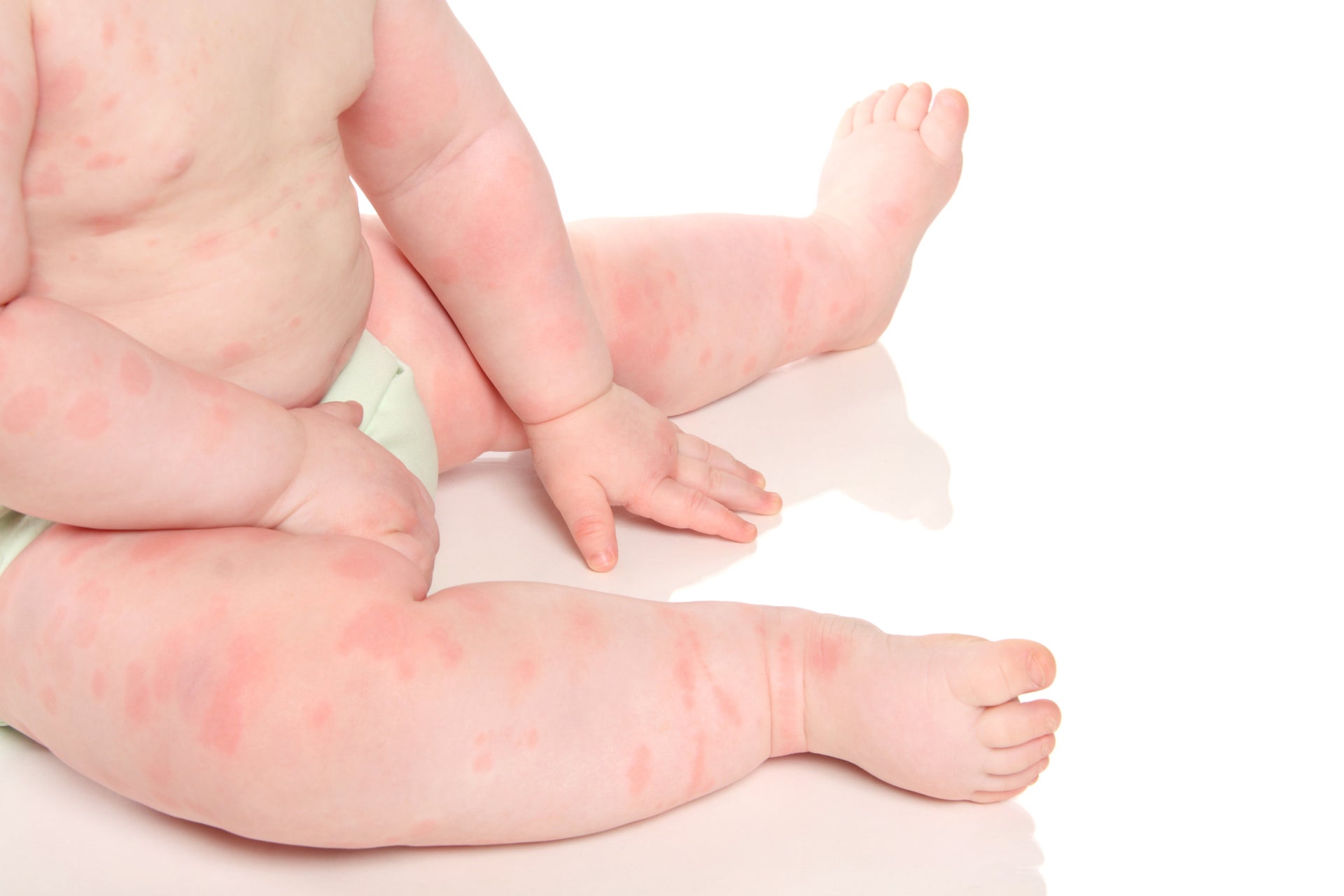 Here's How To Identify Baby Skin Problems | HuffPost UK Parents