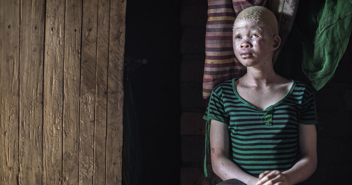 Attacks On Albinos Grow In Malawi As Body Parts Are Sold For Witchcraft ...
