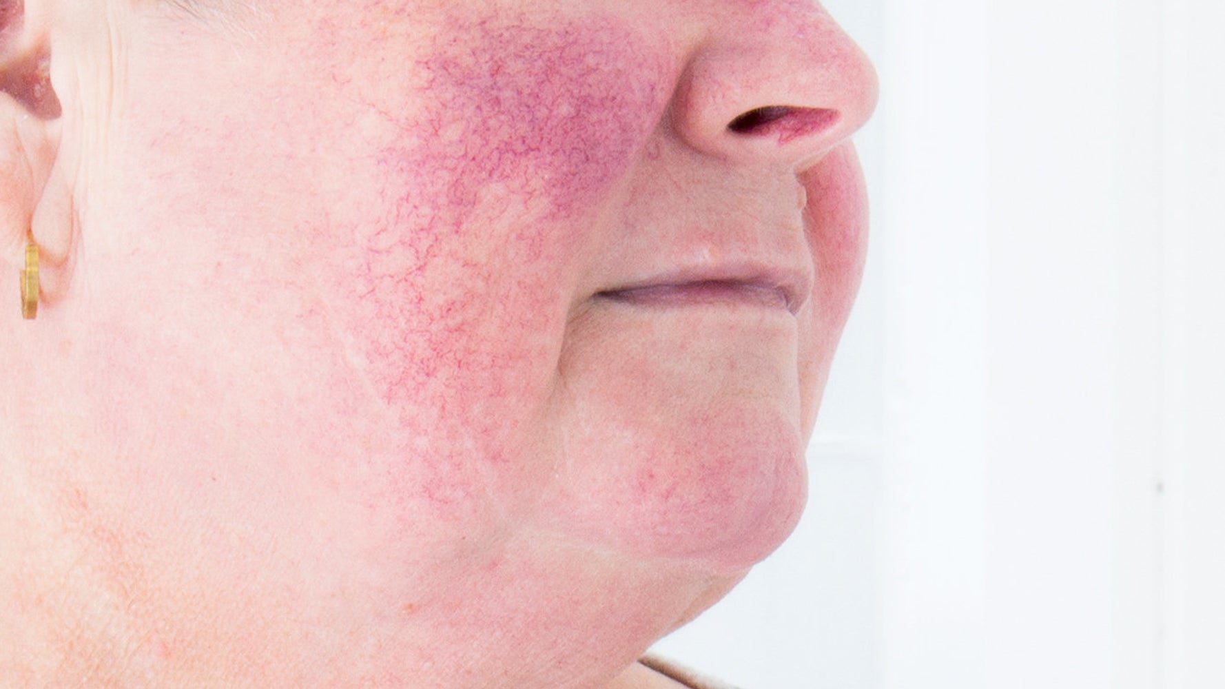 3 Tips And Tricks For Defeating Rosacea In The Winter Huffpost Canada