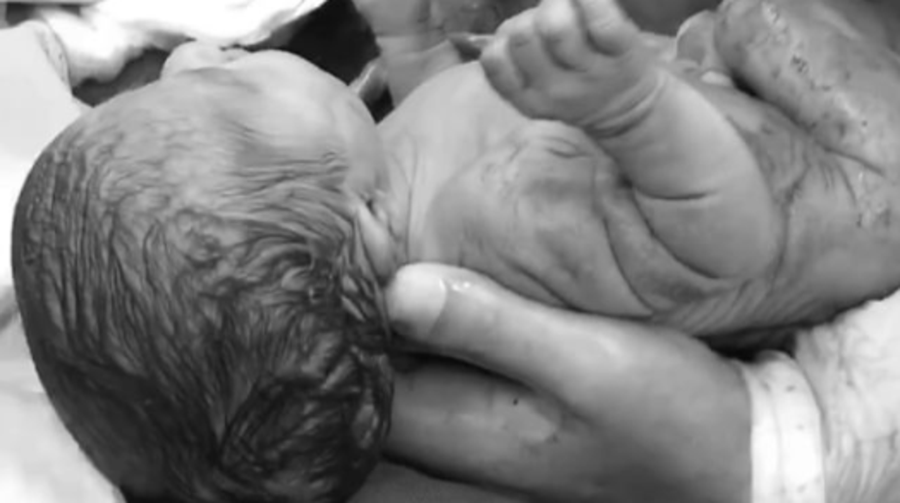 Doctor Captures Video Of 'Gentle Caesarean' Where Baby Is Slowly Lifted ...
