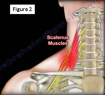 Anterior Scalene Syndrome