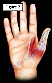 Common Conditions of the Thumb | HuffPost