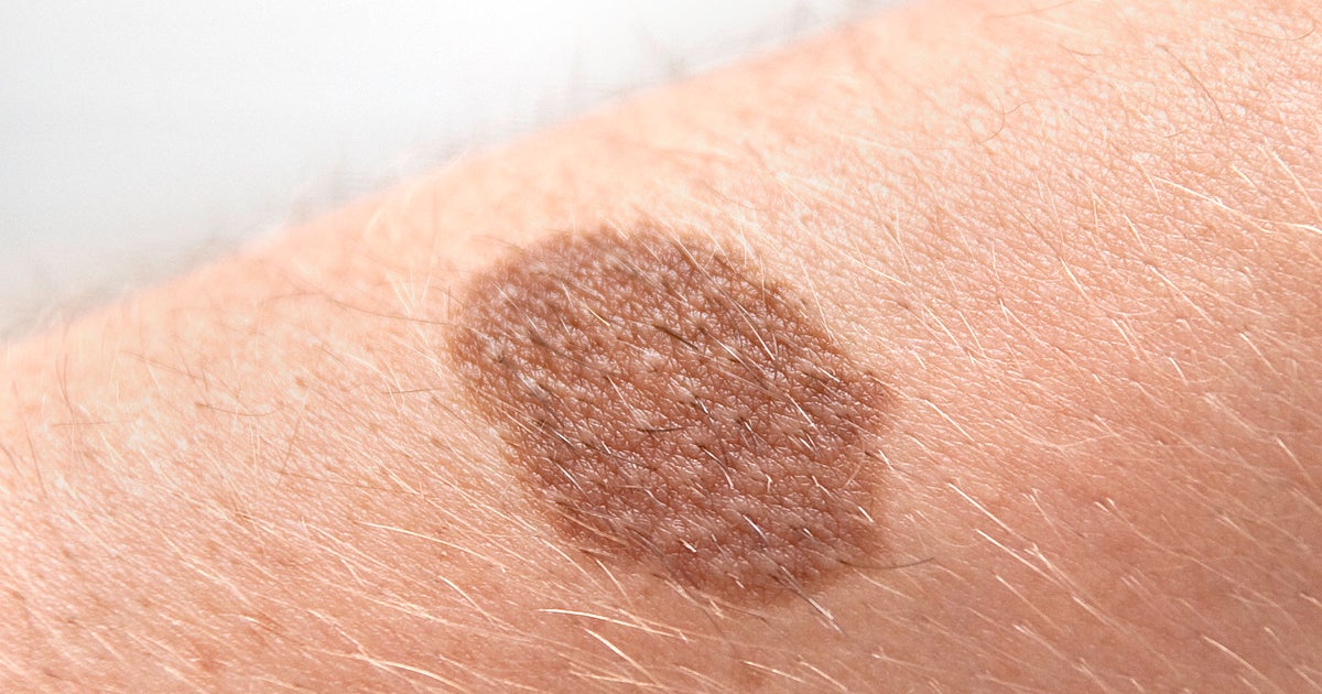 Cancerous Mole Symptoms Revealed In Animation Raising Awareness Of