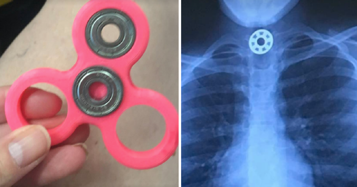 Mum Issues Fidget Spinner Warning After 10-Year-Old Gets Toy Part Stuck ...