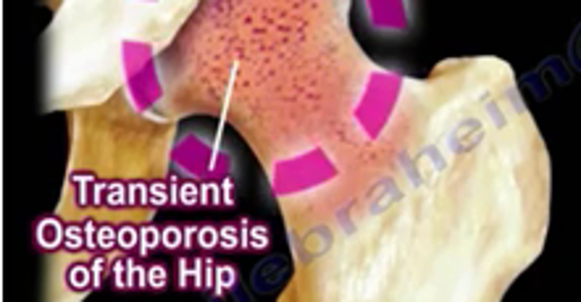 Transient Osteoporosis of the Hip | HuffPost
