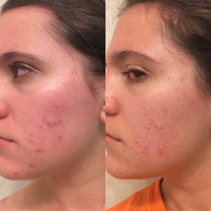 My #CurologyJourney - Day 1 to Day 10 | HuffPost Contributor