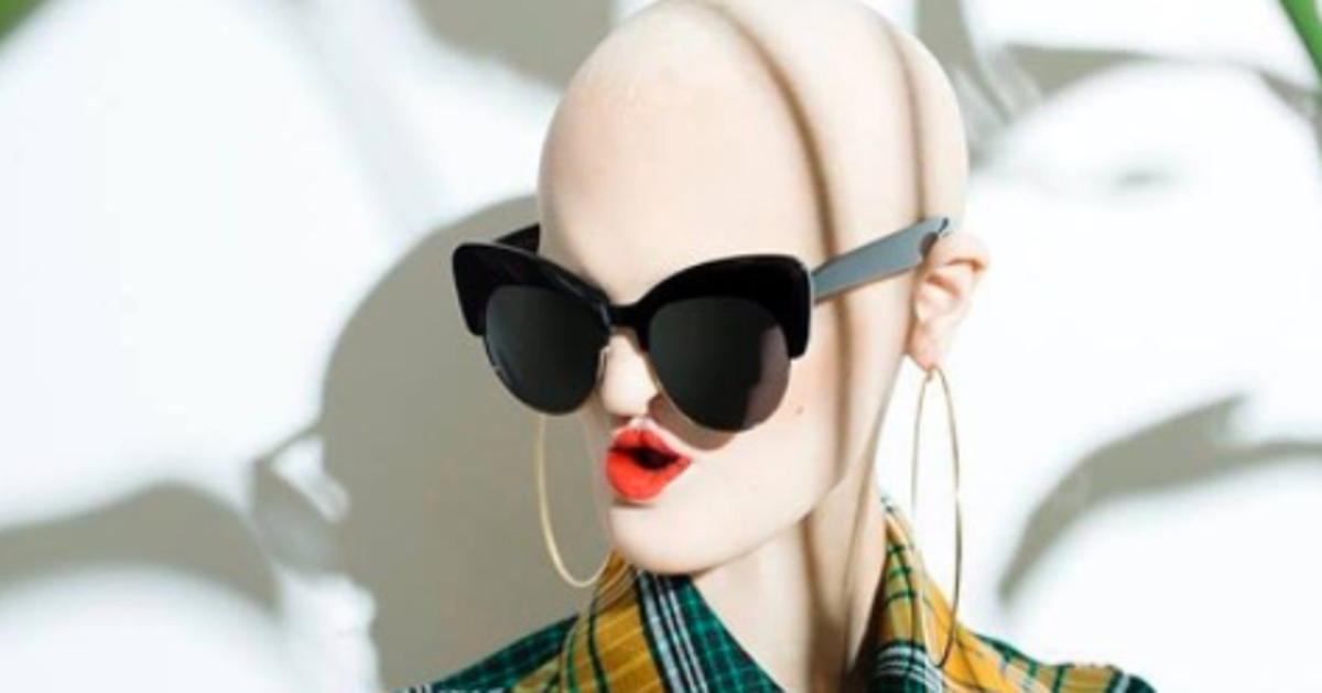 A Model With A Rare Genetic Disorder Is Taking The Fashion World By ...