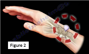 Ganglion Cyst of the Wrist | HuffPost