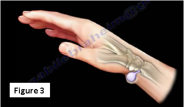 Ganglion Cyst of the Wrist | HuffPost