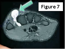 Ganglion Cyst of the Wrist | HuffPost