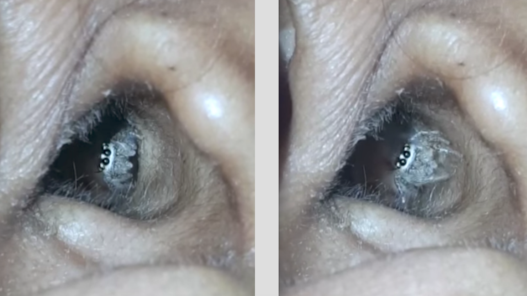Watch This Spider Crawl Out Of A Woman’s Ear, And Try Not To Wince ...