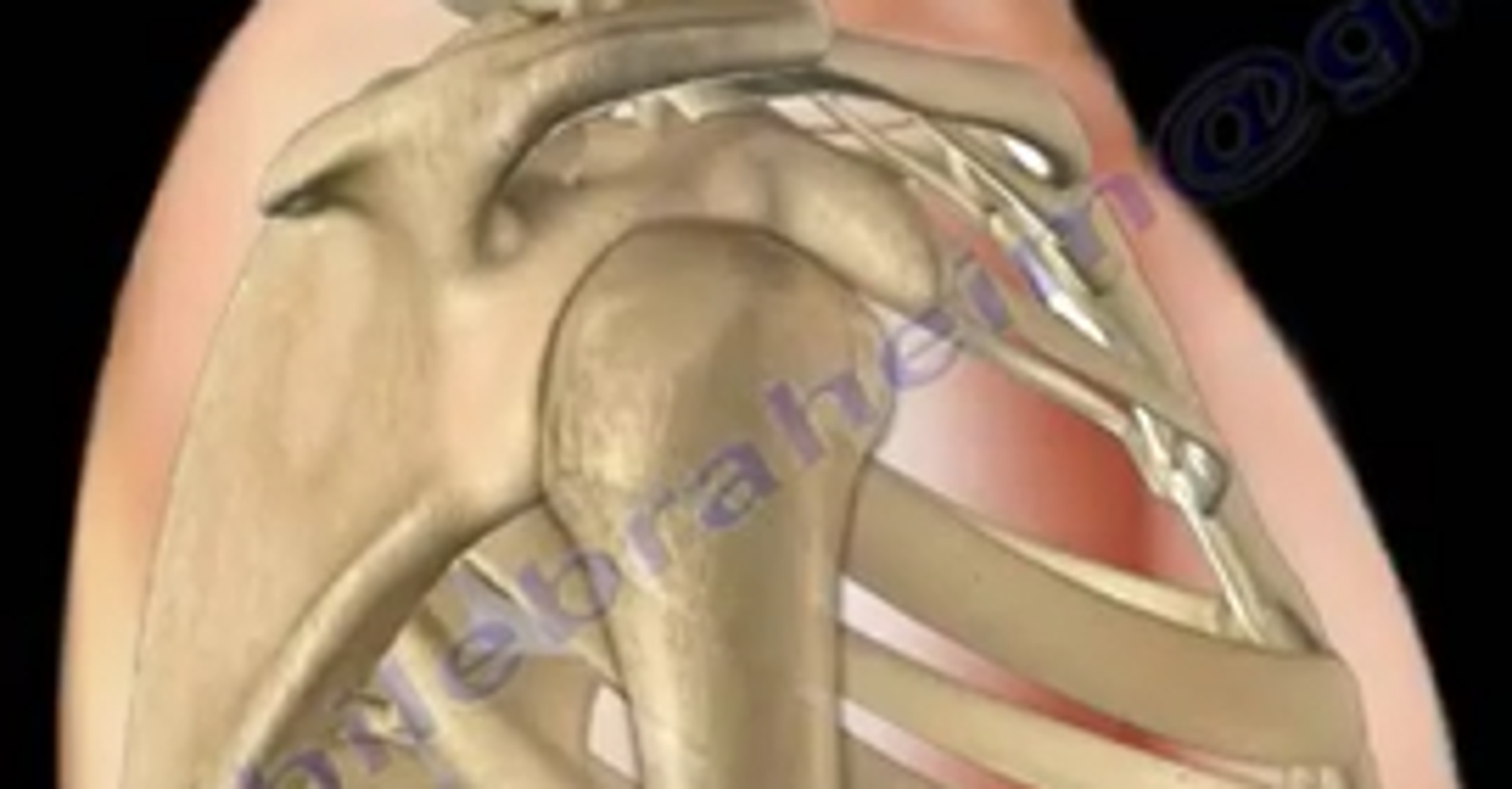 Shoulder Dislocations and Associated Lesions | HuffPost