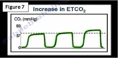 Malignant Hyperthermia Grading Scale