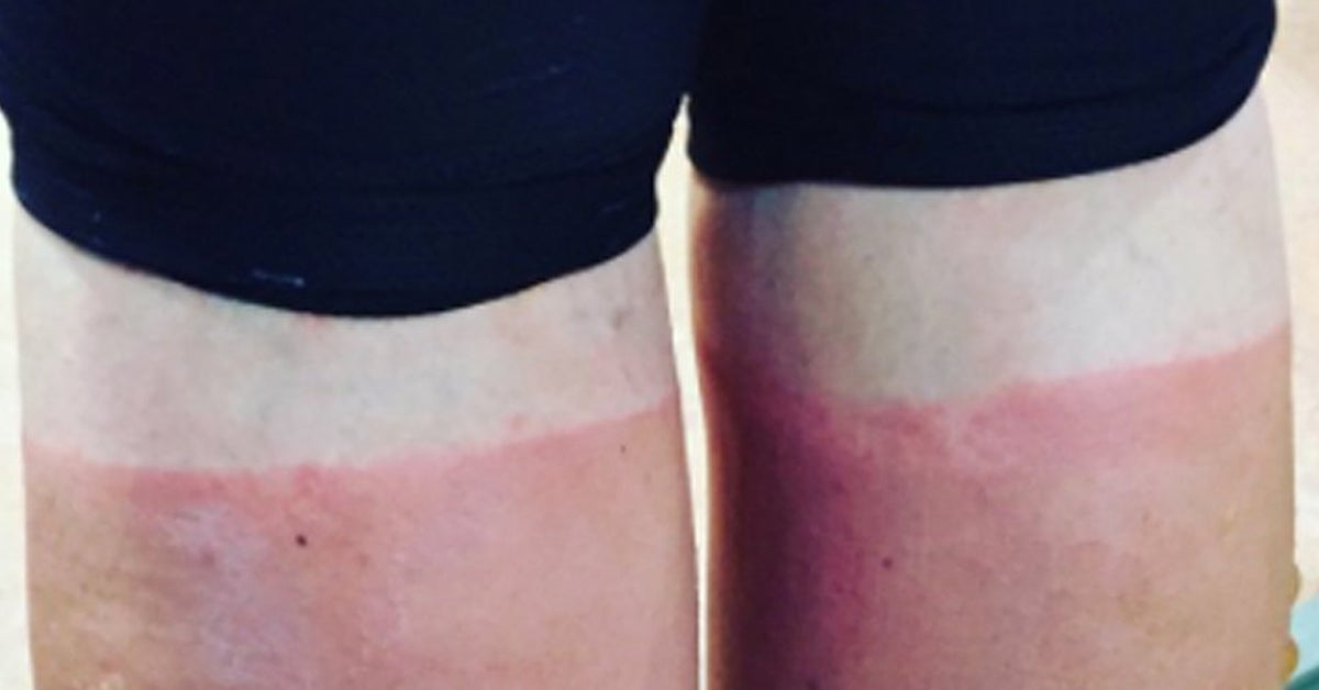 Graphic Images Show Woman's Horrendous Burns After Running 69 Miles In ...