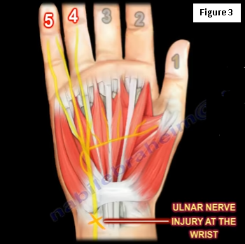 Ulnar Neuropathy Claw Ulnar Nerve Palsy, Claw Hand – Options For
