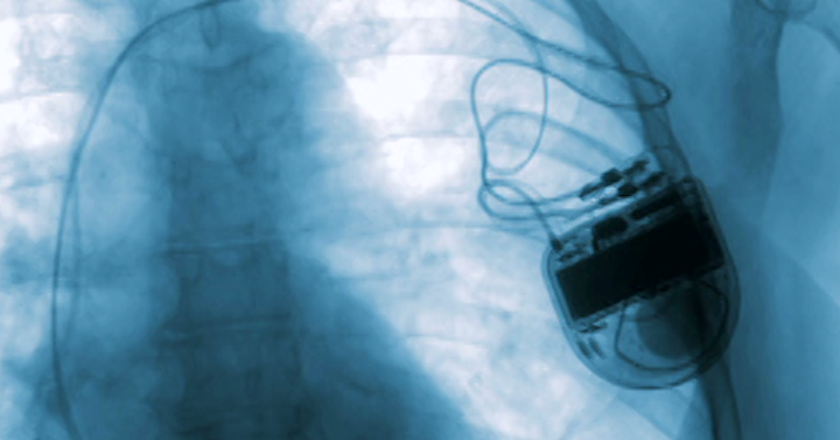 Hacking Risk Leads To Massive Pacemaker Recall | HuffPost Videos