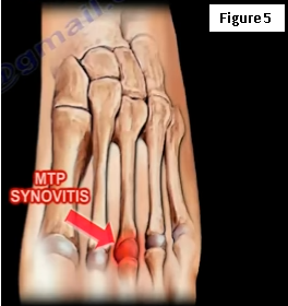 Morton's Neuroma- Interdigital Neuroma | HuffPost