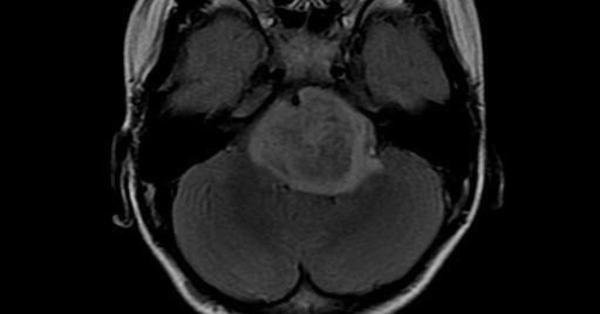 Researchers Have Stopped A Deadly Brain Cancer In Its Tracks In Mice ...