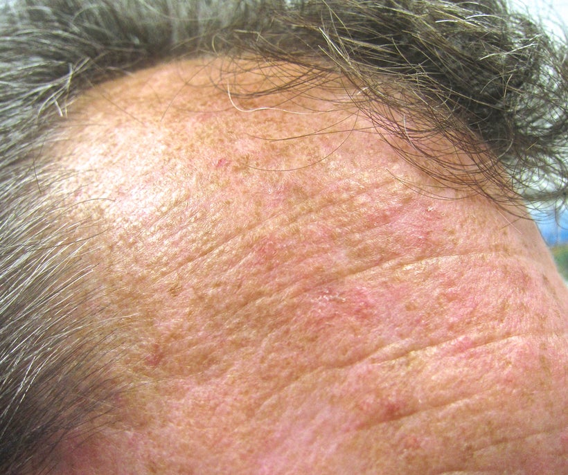 What Everyone Should Know About Skin Cancer | HuffPost