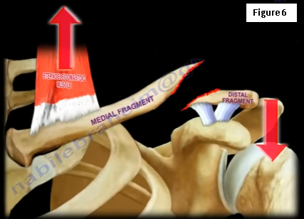 Clavicle Fractures | HuffPost