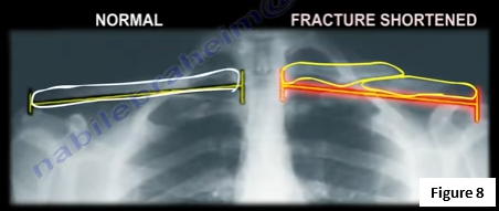 Clavicle Fractures | HuffPost