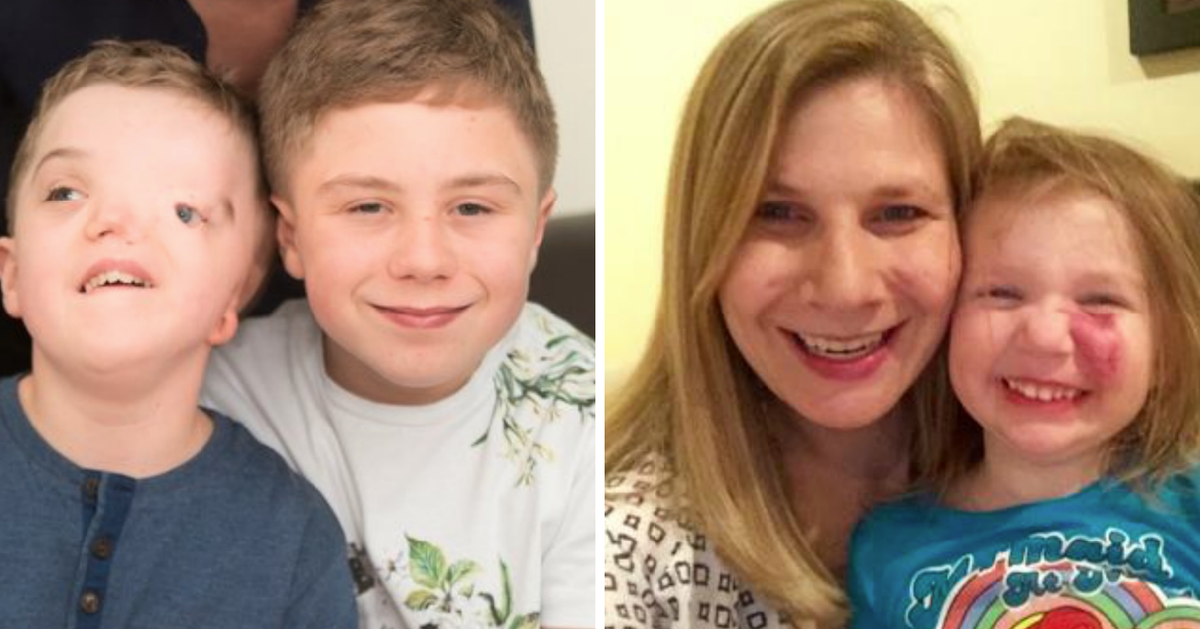 What Parents Of Children With Facial Differences Want You To Tell Your ...