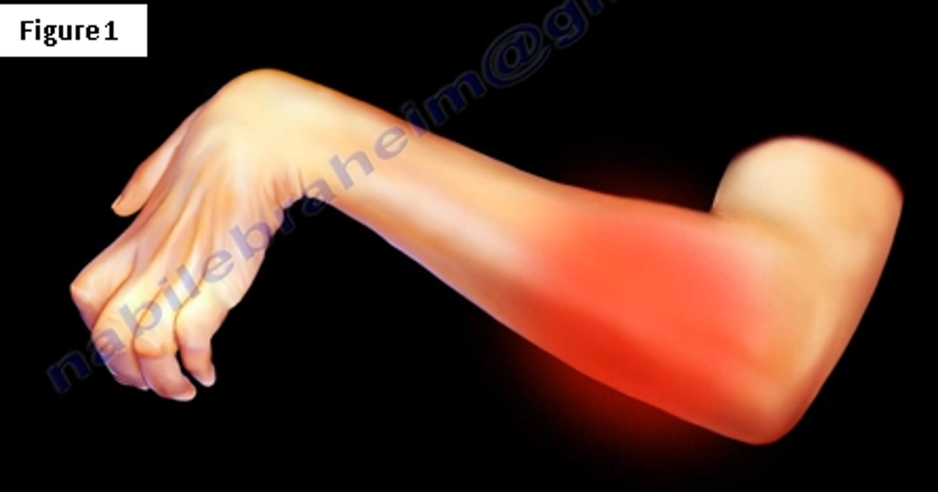 Volkmann’s Ischemic Contracture | HuffPost