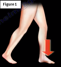 Slap Gait, Steppage Gait, and Foot Drop | HuffPost